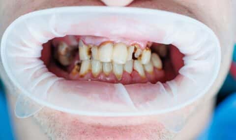 Oral Pathology And 4 Common Oral Diseases